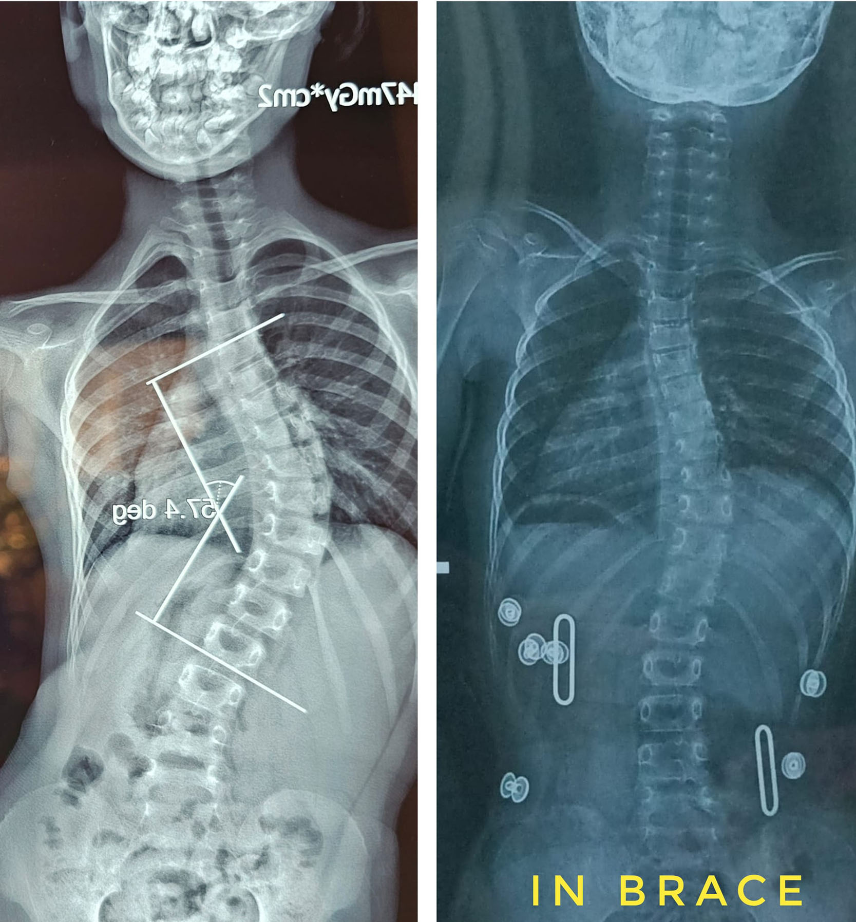 Brace – Physio Link